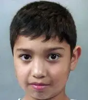 Distraction Osteogenesis | Face & Jaw Surgery Center