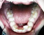 Distraction Osteogenesis | Face & Jaw Surgery Center